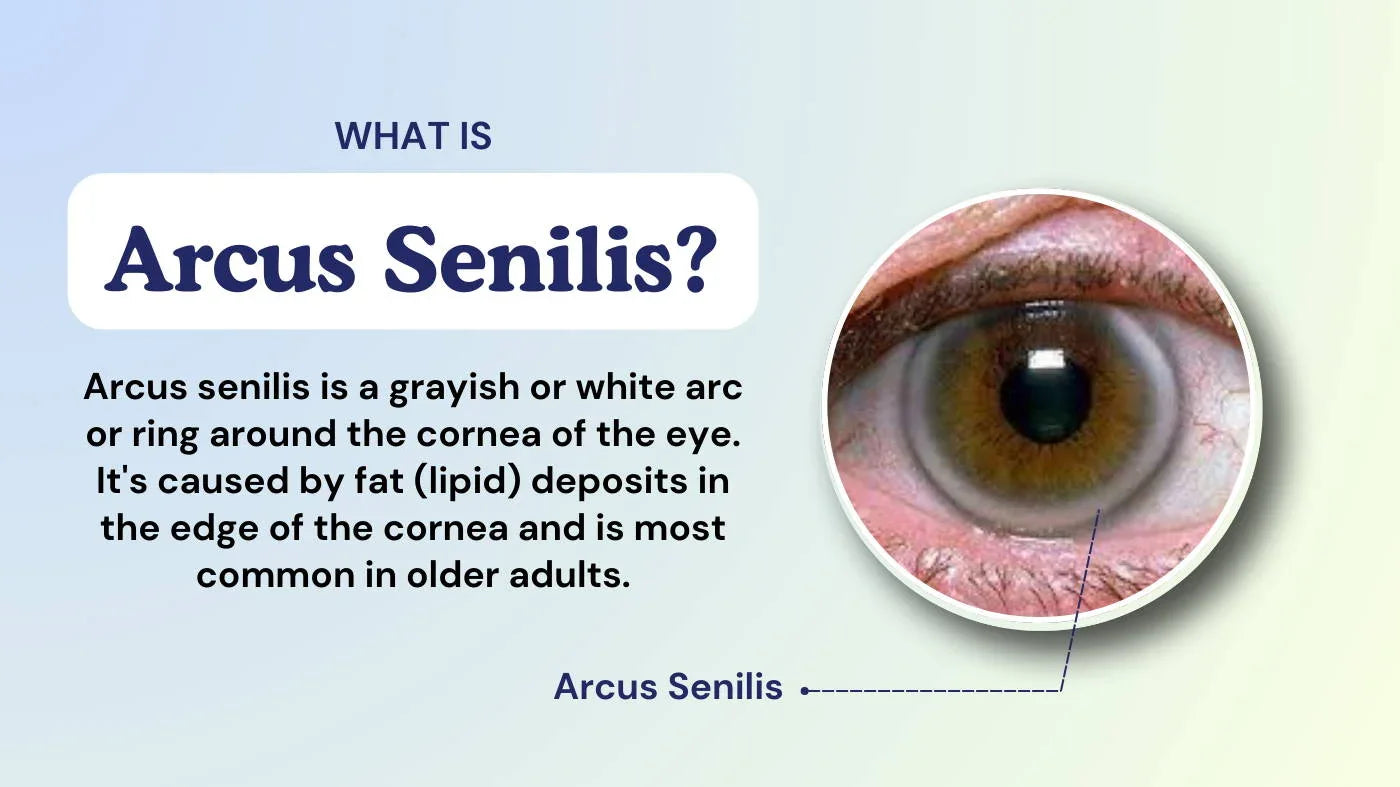Can Colored Contacts Cover Arcus Senilis? What You Need to Know ...