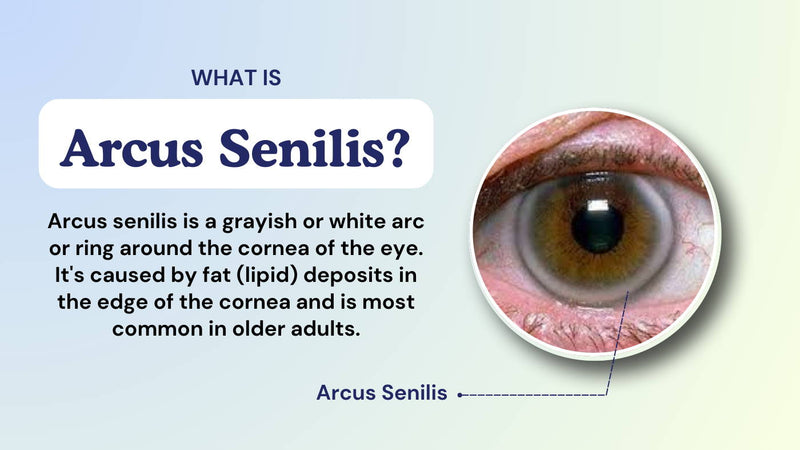 Can Colored Contacts Cover Arcus Senilis? What You Need to Know ...